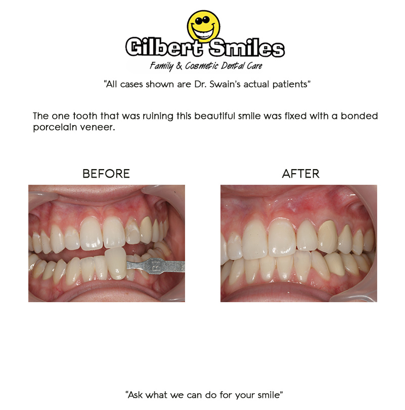 Before & After - Gilbert Smiles