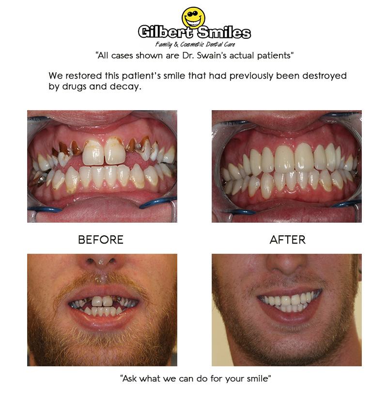 Before & After - Gilbert Smiles