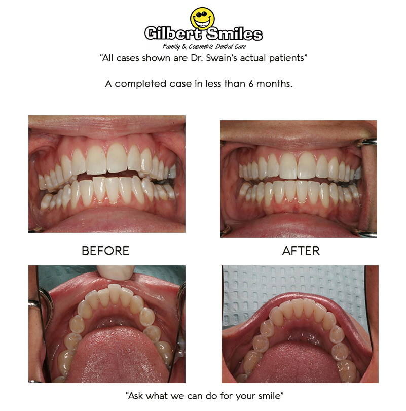 Before & After - Gilbert Smiles