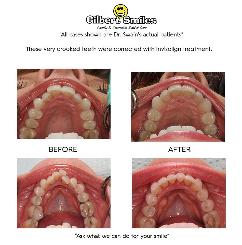 Before & After - Gilbert Smiles